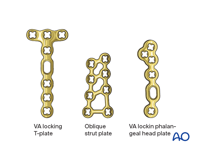 Bridge plating for Wedge/multifragmentary extraarticular fracture of ...