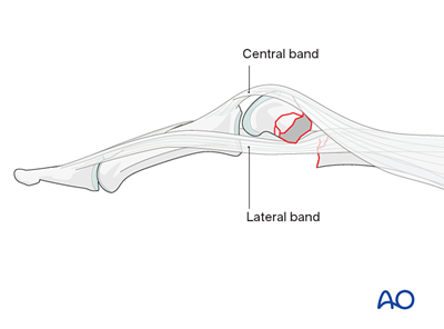 Bridge plating for Wedge/multifragmentary extraarticular fracture of ...
