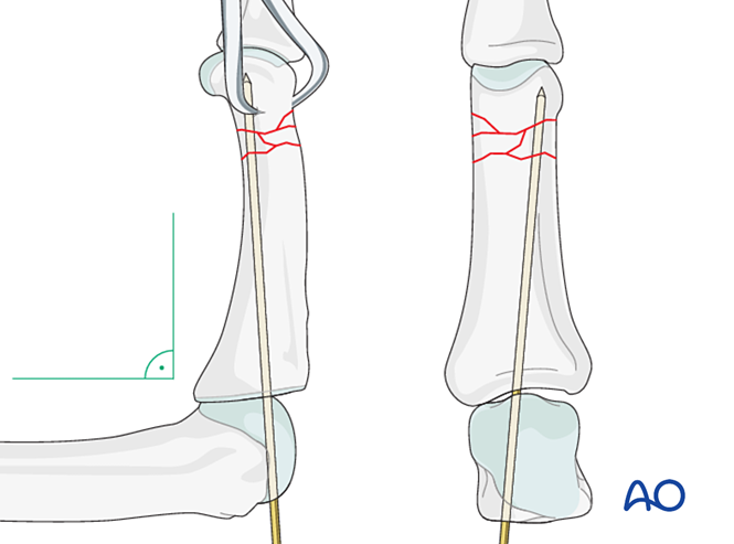 Bridge plating for Wedge/multifragmentary extraarticular fracture of ...