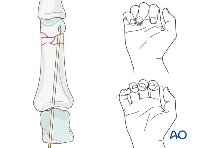 Bridge plating for Wedge/multifragmentary extraarticular fracture of ...