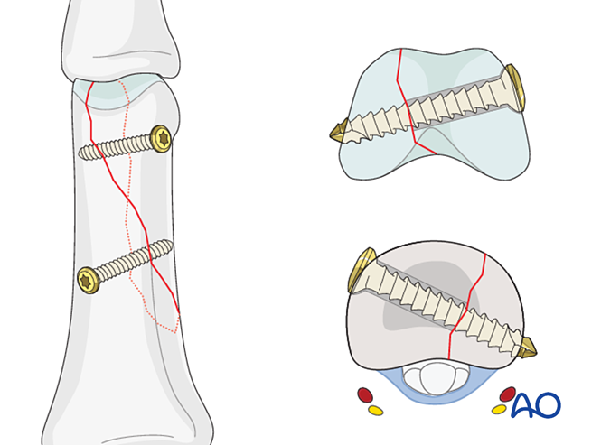 Lag-screw fixation for Partial articular fracture of the distal end segment