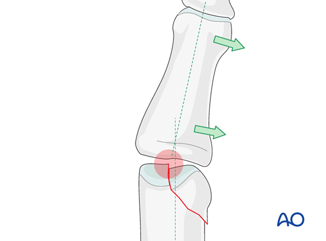 K Wire Fixation For Dislocation And Fracture Dislocation Of The