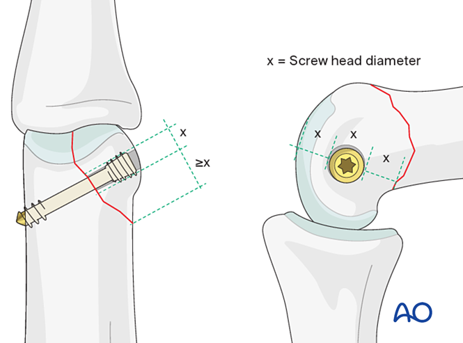 Lag-screw fixation for Partial articular fracture of the distal end segment