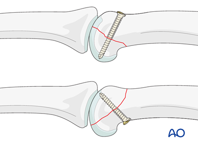 Lag-screw fixation for Dislocation and fracture-dislocation of the ...