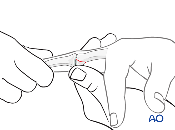 Lag-screw fixation for Dislocation and fracture-dislocation of the ...