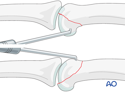 Lag-screw fixation for Dislocation and fracture-dislocation of the ...