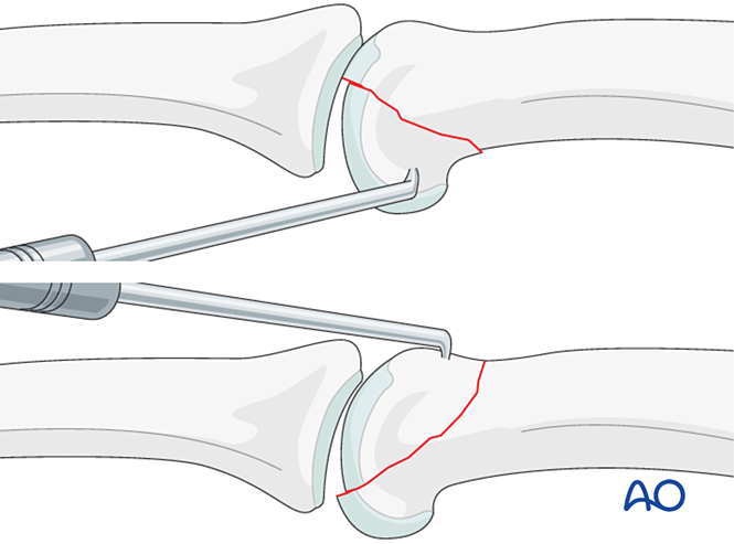 Lag-screw fixation for Dislocation and fracture-dislocation of the ...