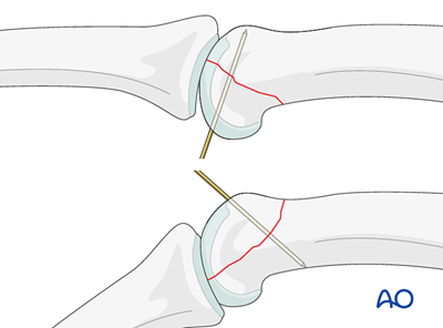 Lag-screw fixation for Dislocation and fracture-dislocation of the ...