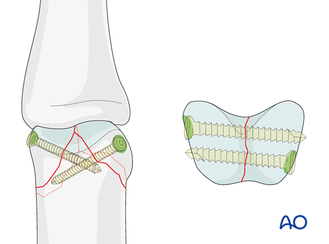 Lag-screw fixation for Complete articular fracture of the distal end ...