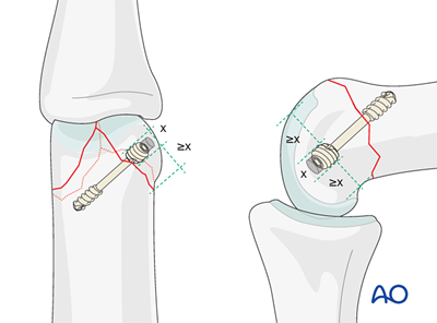 Lag-screw fixation for Complete articular fracture of the distal end ...