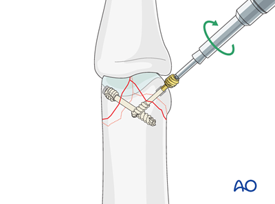 Lag-screw fixation for Complete articular fracture of the distal end ...