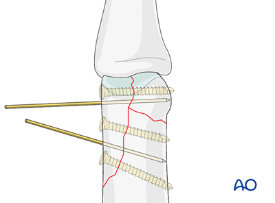 Lag-screw fixation for Complete articular fracture of the distal end ...