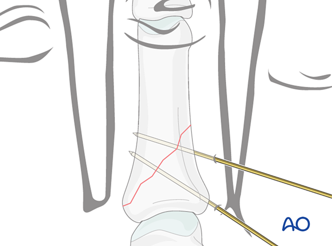 K-wire fixation for Oblique extraarticular fracture of the proximal end ...
