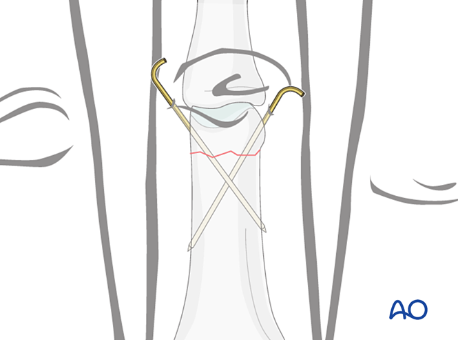 K Wire Fixation For Transverse Extraarticular Fracture Of The Distal
