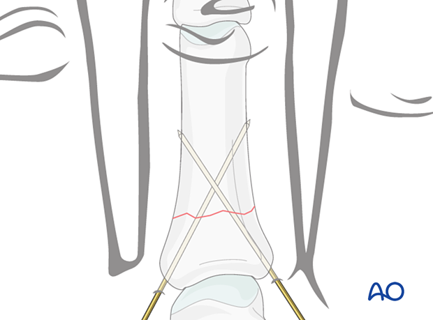 K Wire Fixation For Transverse Extraarticular Fracture Of The Proximal