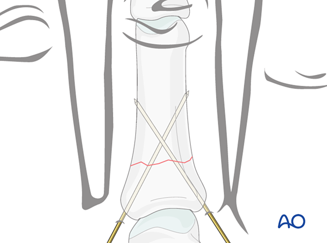 K-wire fixation for Transverse extraarticular fracture of the proximal ...