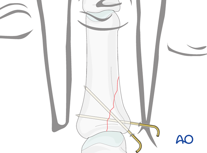 K-wire fixation for Partial articular fracture of the proximal end segment