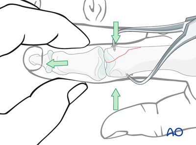 K-wire fixation for Dislocation and fracture-dislocation of the ...