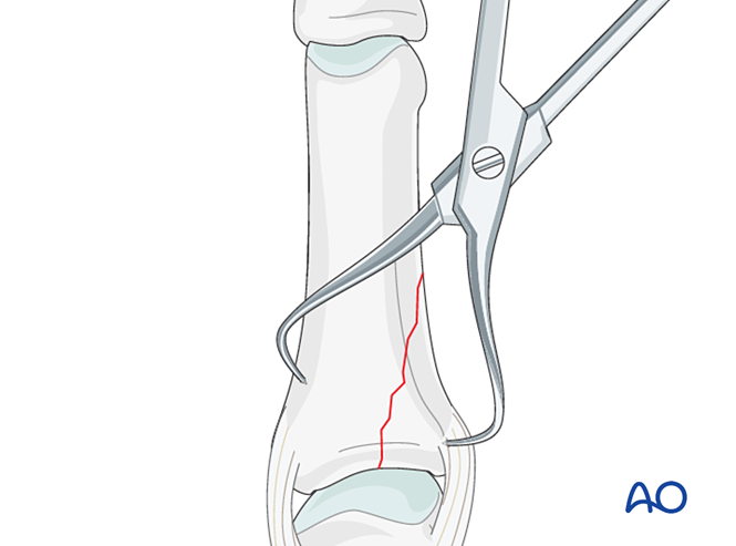 K-wire fixation for Partial articular fracture of the proximal end segment