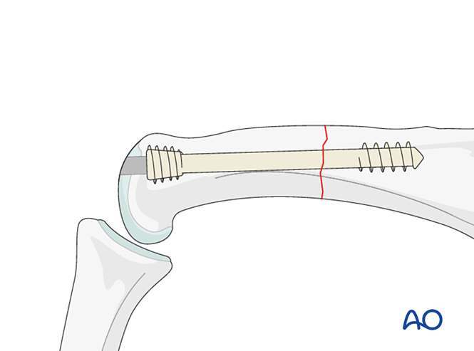 Intramedullary screw fixation for Transverse fracture of the diaphysis