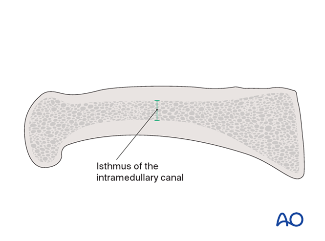 Intramedullary screw fixation for Transverse extraarticular fracture of ...