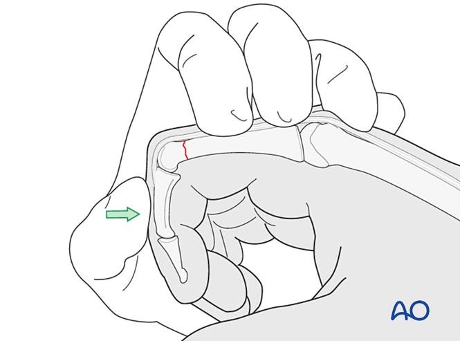 Intramedullary screw fixation for Transverse extraarticular fracture of ...