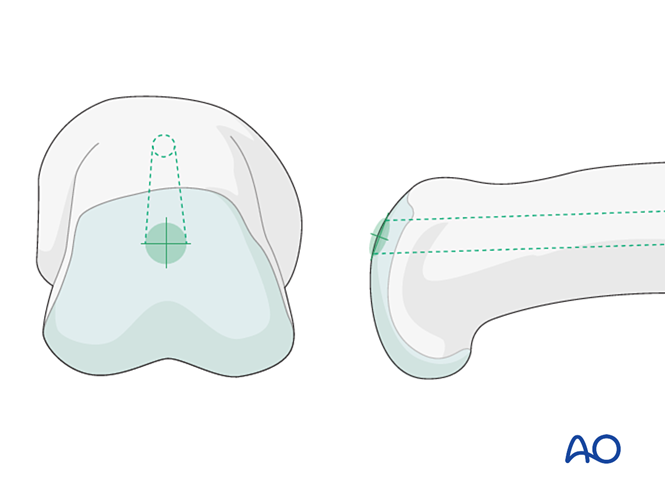 Intramedullary screw fixation for Transverse fracture of the diaphysis