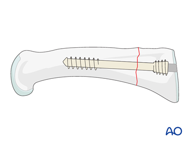 Intramedullary screw fixation for Transverse extraarticular fracture of ...