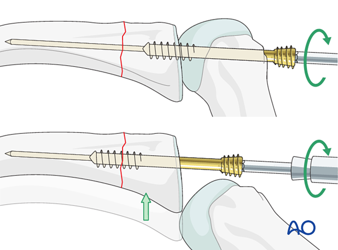 Intramedullary screw fixation for Transverse extraarticular fracture of ...