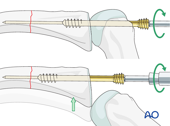 Antegrade intramedullary screw fixation