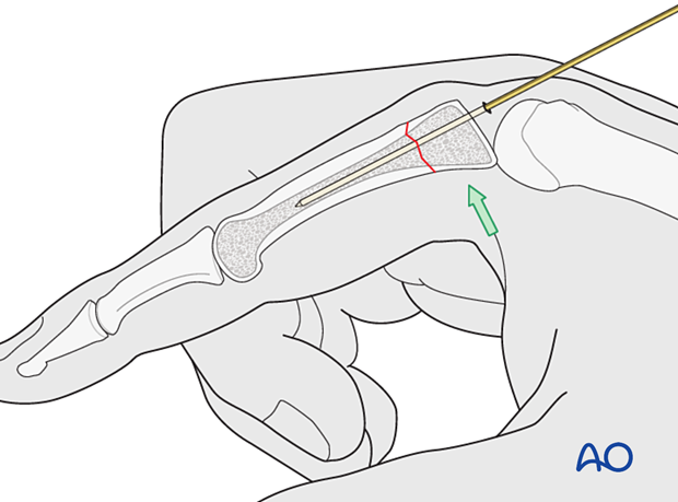 Intramedullary Screw Fixation For Transverse Extraarticular Fracture Of
