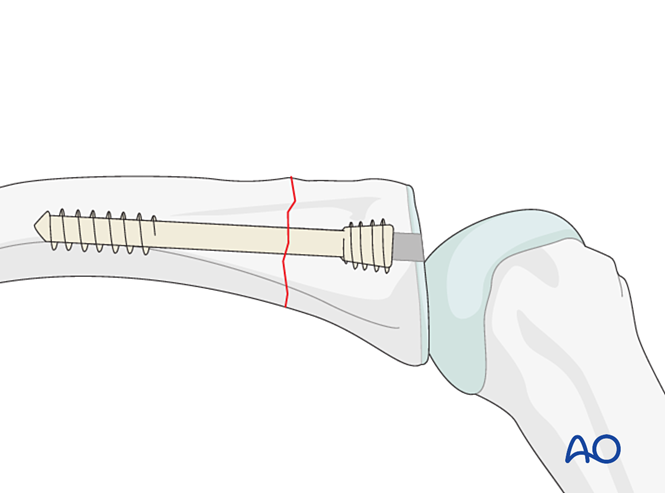 Intramedullary Screw Fixation For Transverse Extraarticular Fracture Of