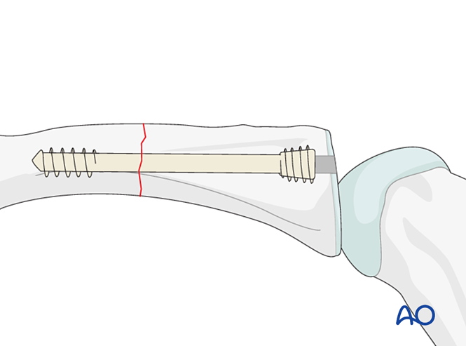 Antegrade intramedullary screw fixation