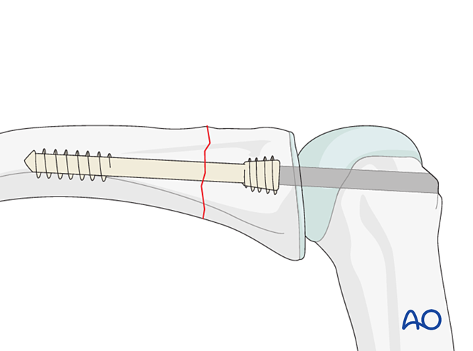 Intramedullary screw fixation for Transverse extraarticular fracture of ...