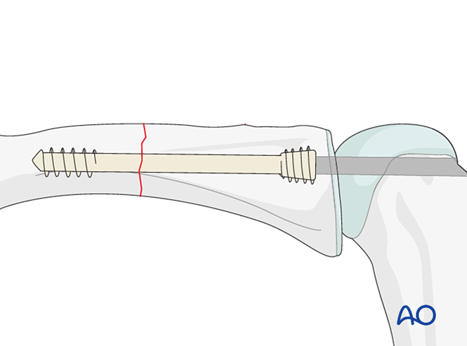 Antegrade intramedullary screw fixation