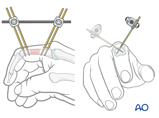 External fixation for Wedge/multifragmentary fracture of the diaphysis