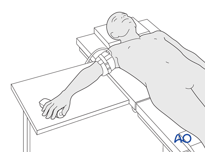 Intramedullary K Wire Fixation For Extraarticular Fracture Of The