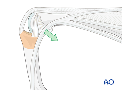 Dorsal approach to the PIP joint