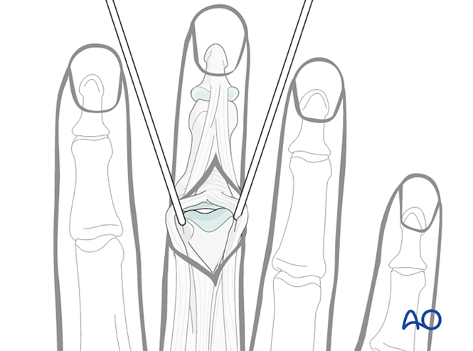 Dorsal approach to the PIP joint