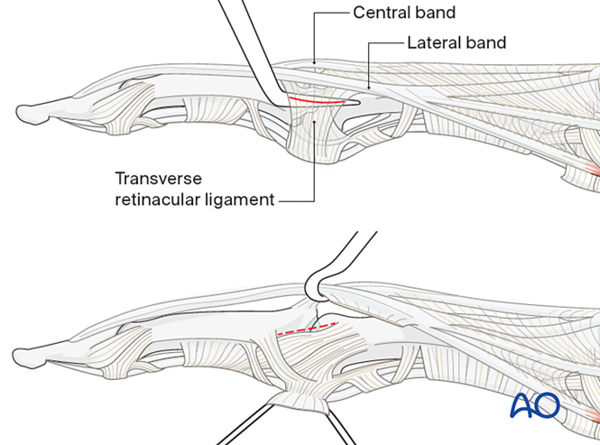 Dorsal approach to the PIP joint