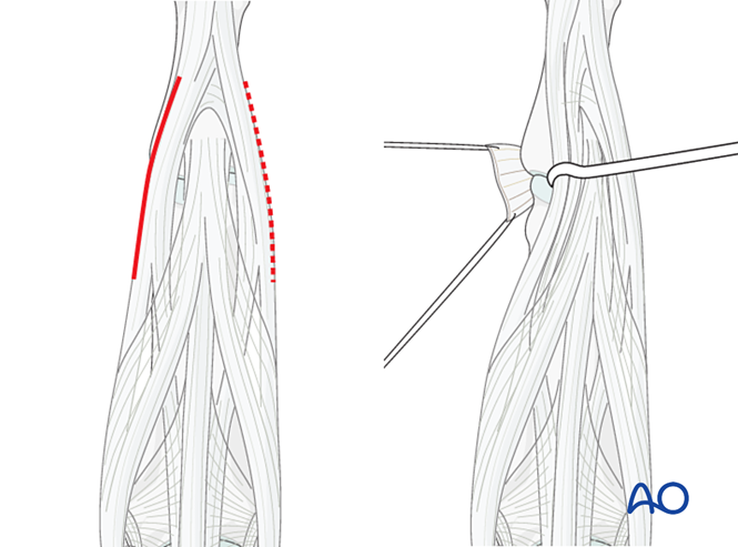 Dorsal approach to the PIP joint