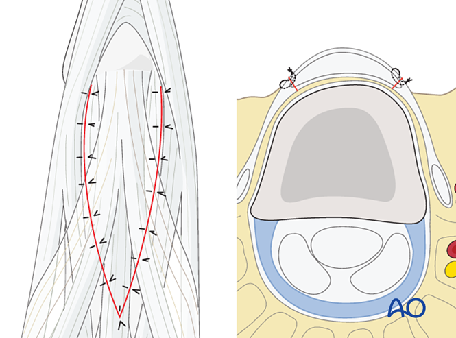 Dorsal approach to the PIP joint