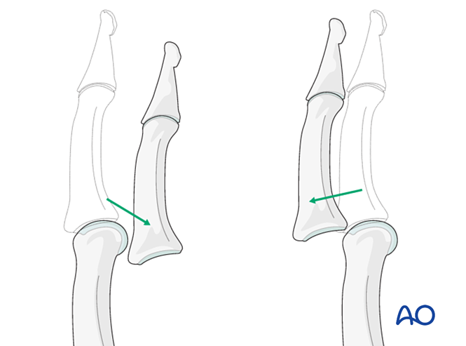 Dislocation of the proximal interphalangeal joint