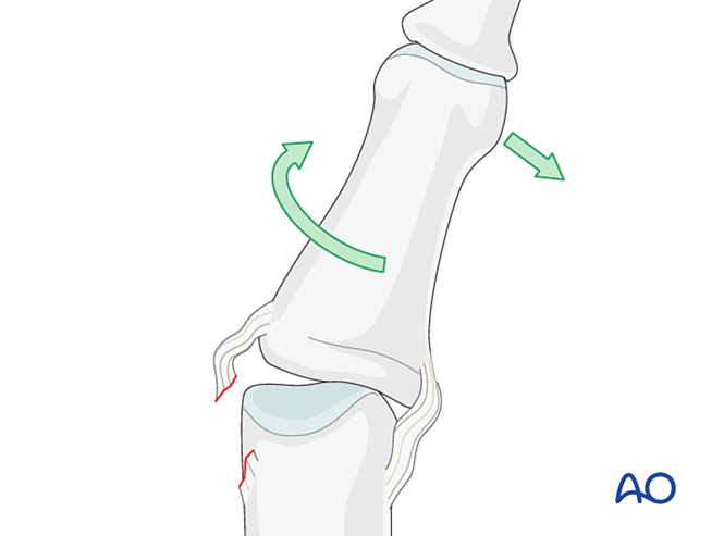 Dislocation of the proximal interphalangeal joint
