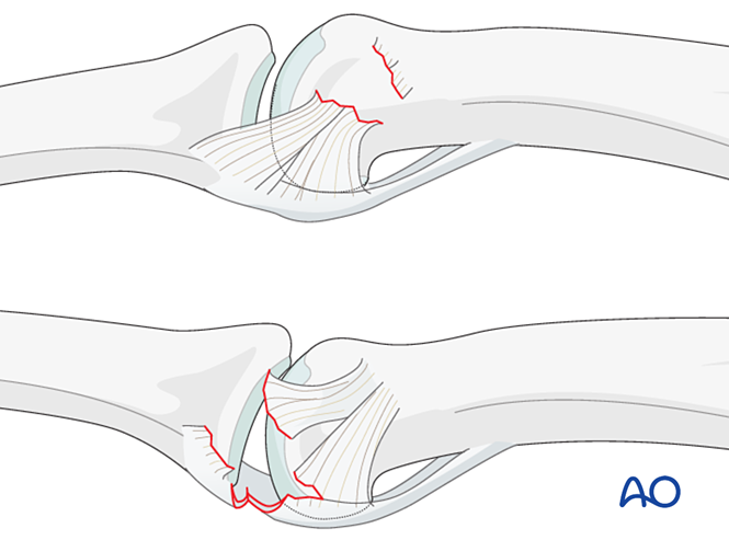 Dislocation of the proximal interphalangeal joint