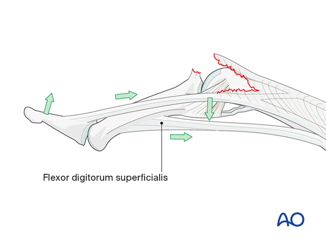 Dorsal avulsion of the proximal end segment