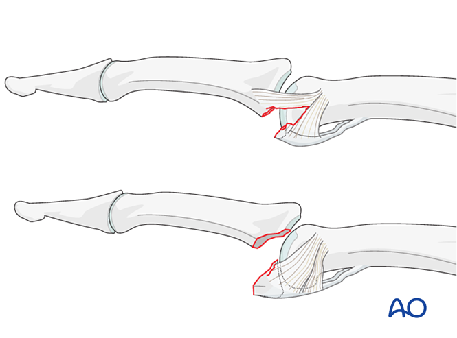 Volar plate avulsion of the proximal end segment