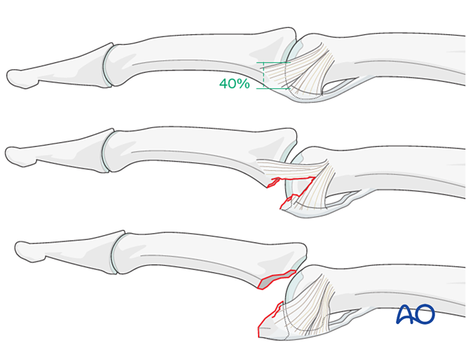 Volar plate avulsion of the proximal end segment