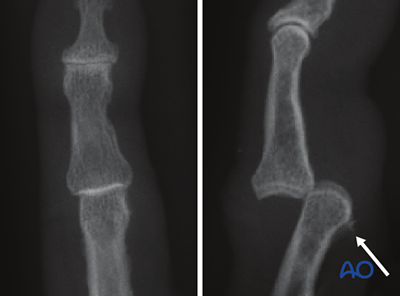 Volar plate avulsion of the proximal end segment