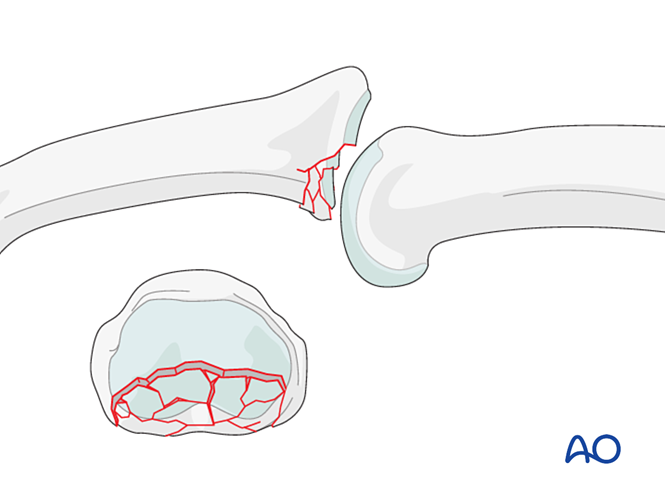 Volar plate avulsion of the proximal end segment